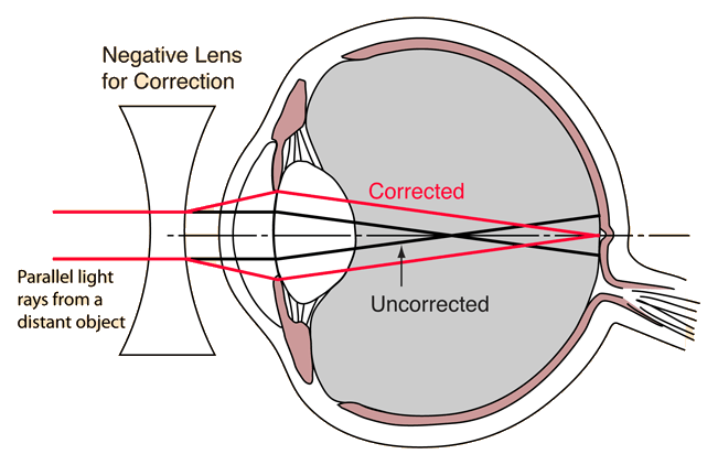 How to solve nearsightedness using physics – Isaac's science blog